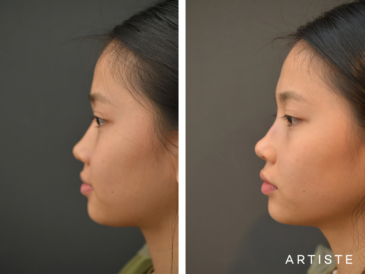 Chin Fillers Before And After Asian