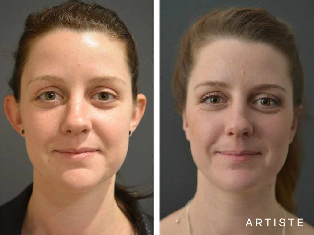 Otoplasty Gallery | Artiste Plastic Surgery