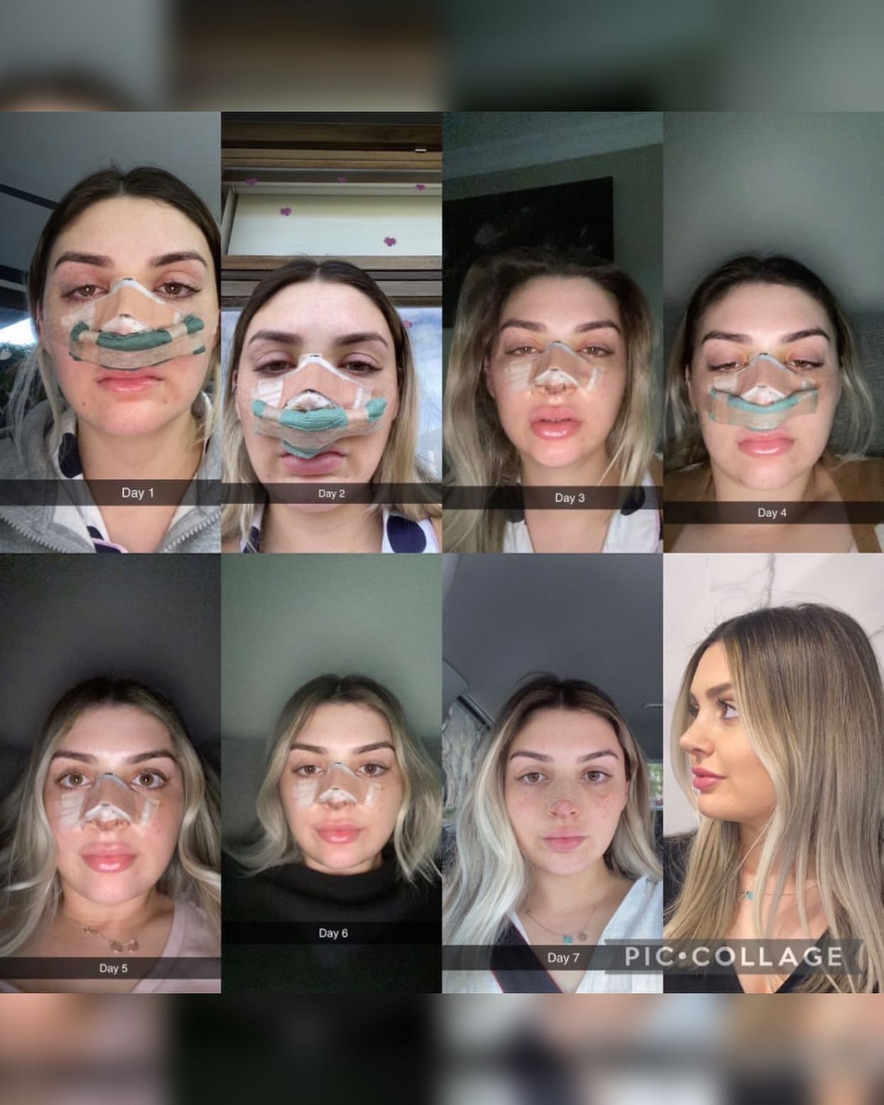 Rhinoplasty Recovery