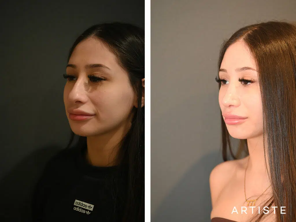 Natural Rhinoplasty | Artiste Plastic Surgery
