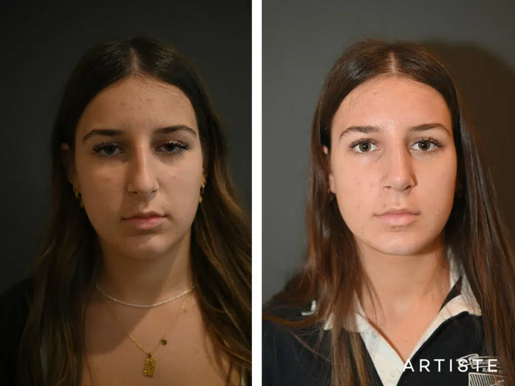 Natural Rhinoplasty | Artiste Plastic Surgery