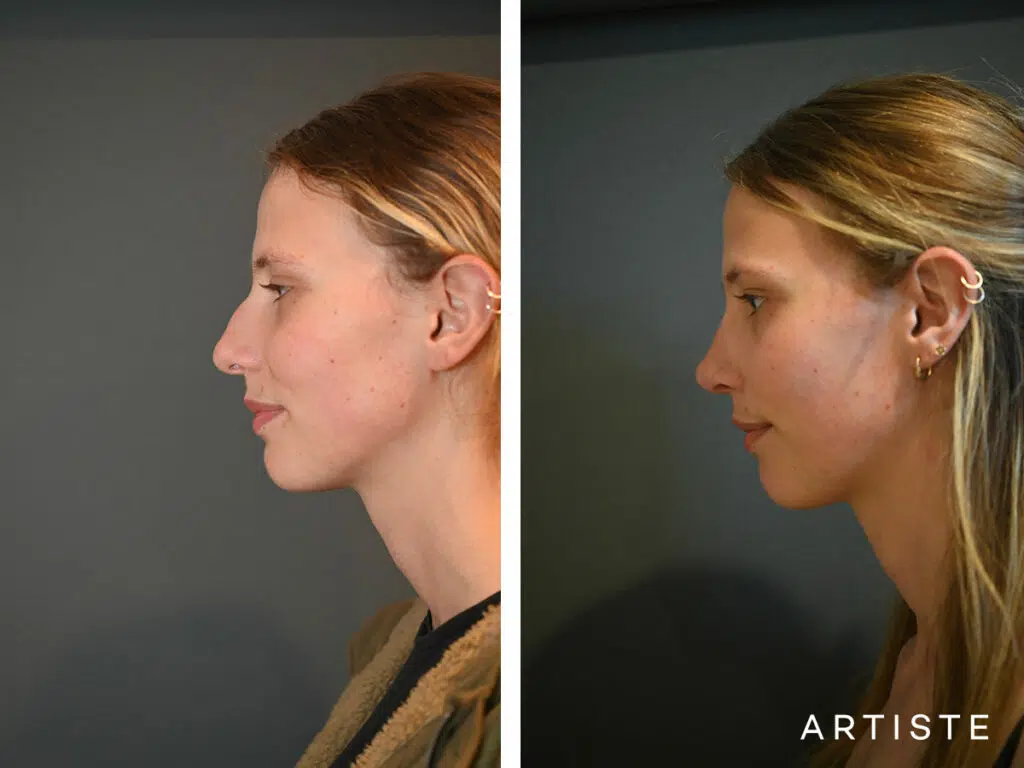 Natural Rhinoplasty | Artiste Plastic Surgery