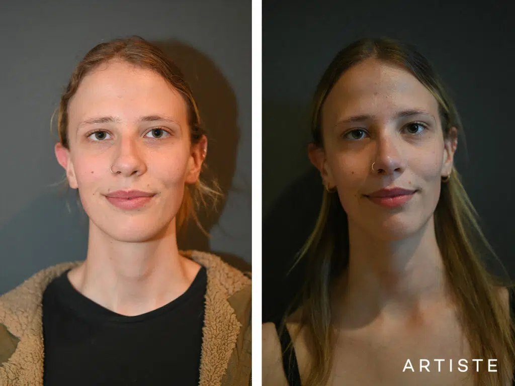 Natural Rhinoplasty | Artiste Plastic Surgery