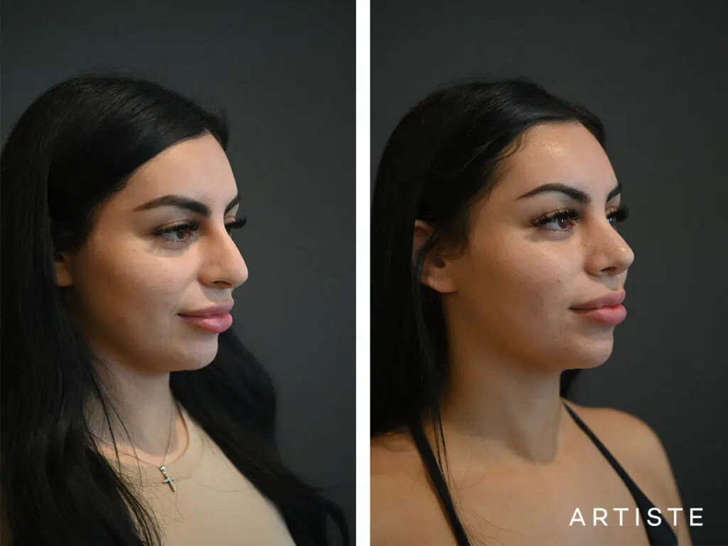 Before & After Ethnic Rhinoplasty Gallery | Artiste Plastic Surgery
