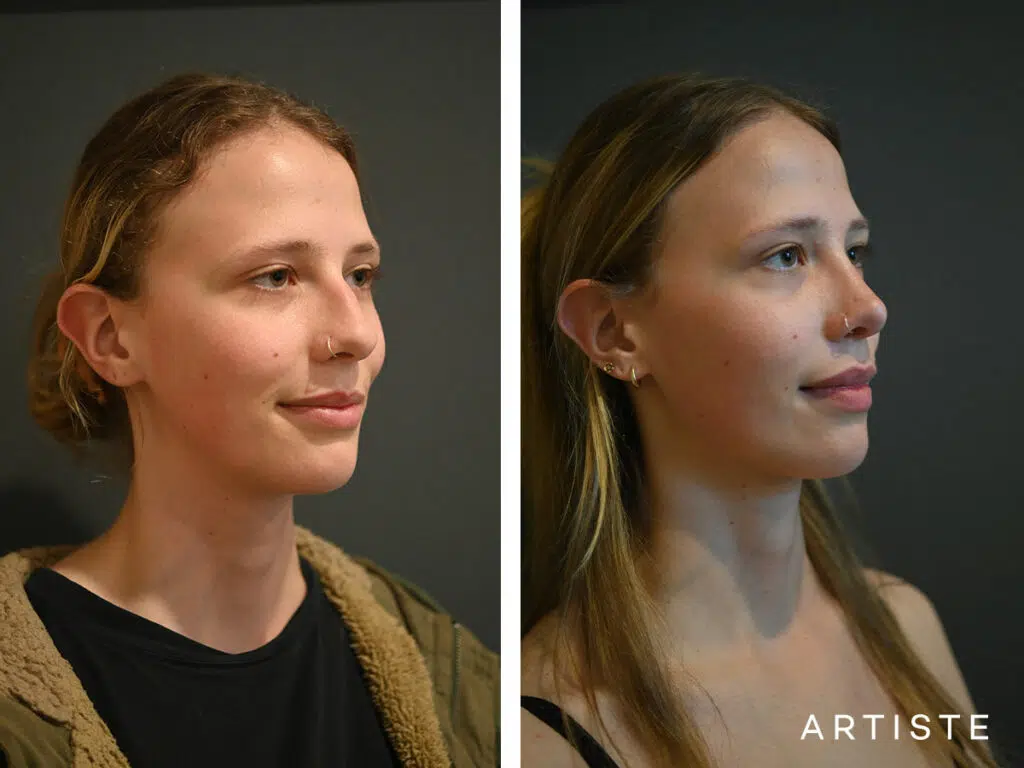 Natural Rhinoplasty | Artiste Plastic Surgery