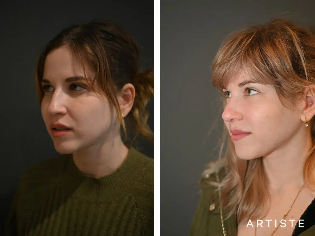Natural Rhinoplasty | Artiste Plastic Surgery