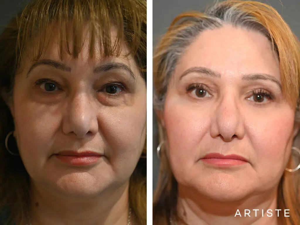 Lower Eyelid Surgery Gallery | Artiste Plastic Surgery
