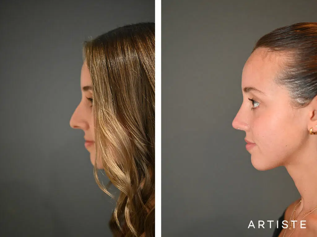 Natural Rhinoplasty | Artiste Plastic Surgery