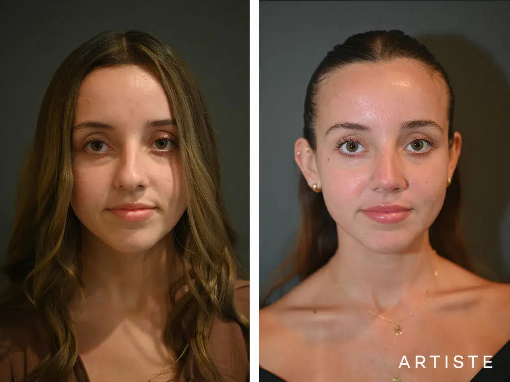 Natural Rhinoplasty | Artiste Plastic Surgery