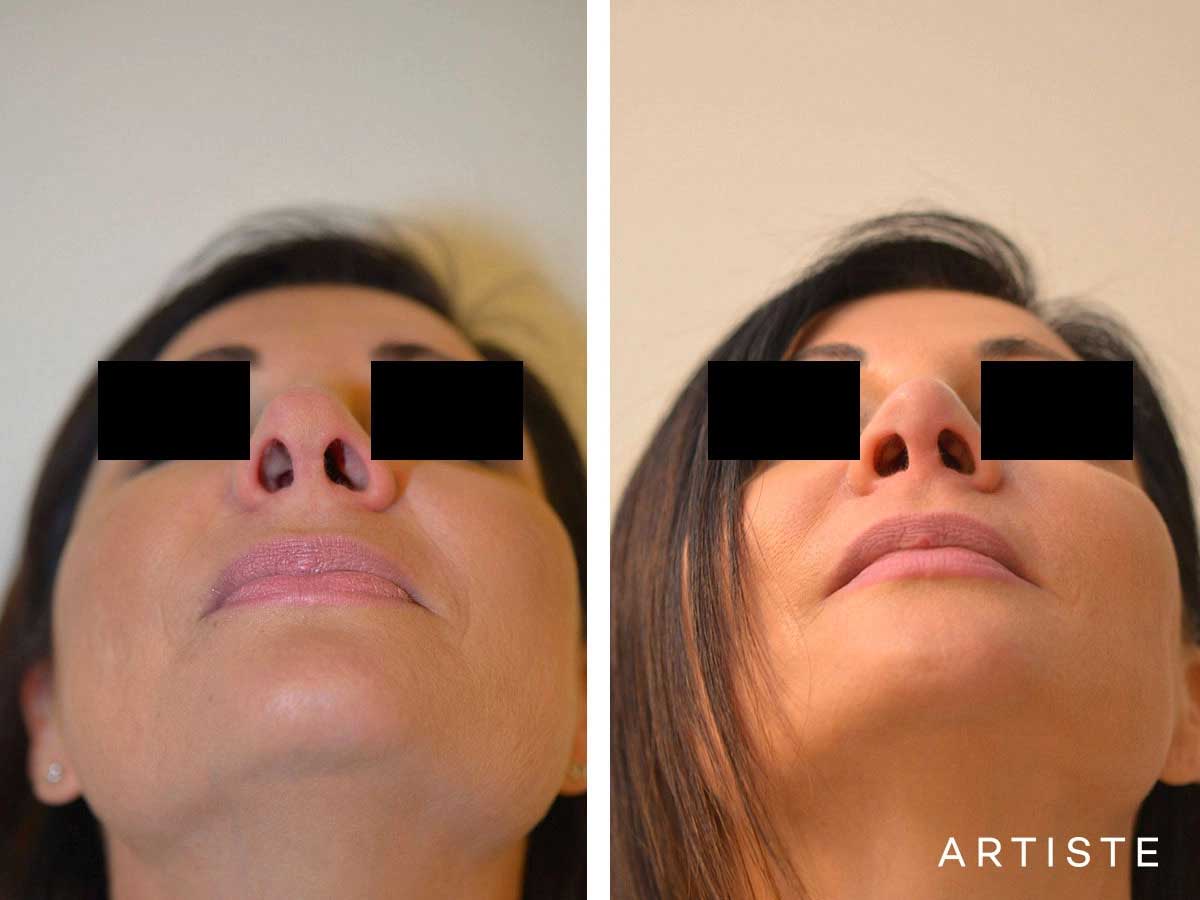 Botched Nose Job