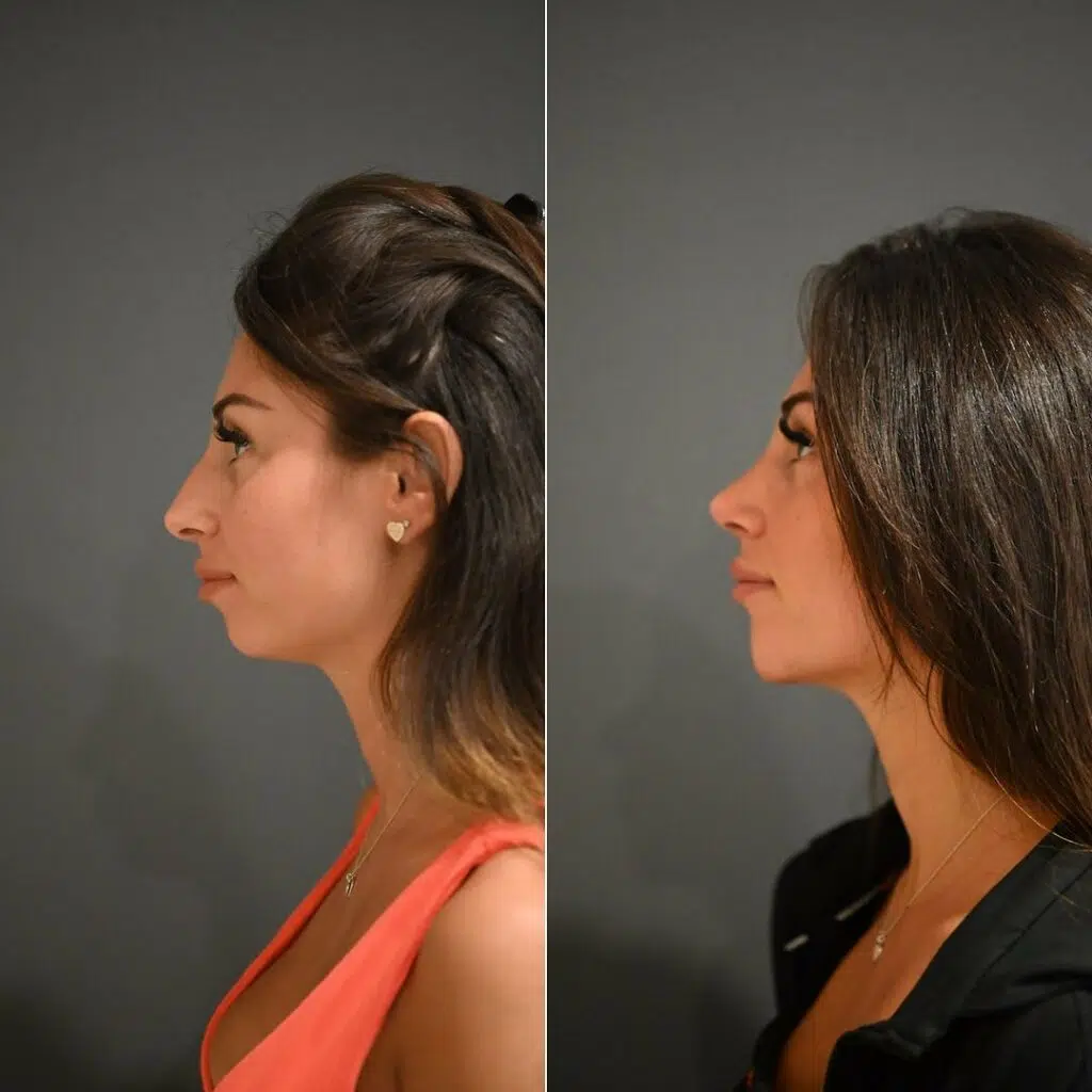 Facial Implants vs Injections for Volume | Artiste Plastic Surgery